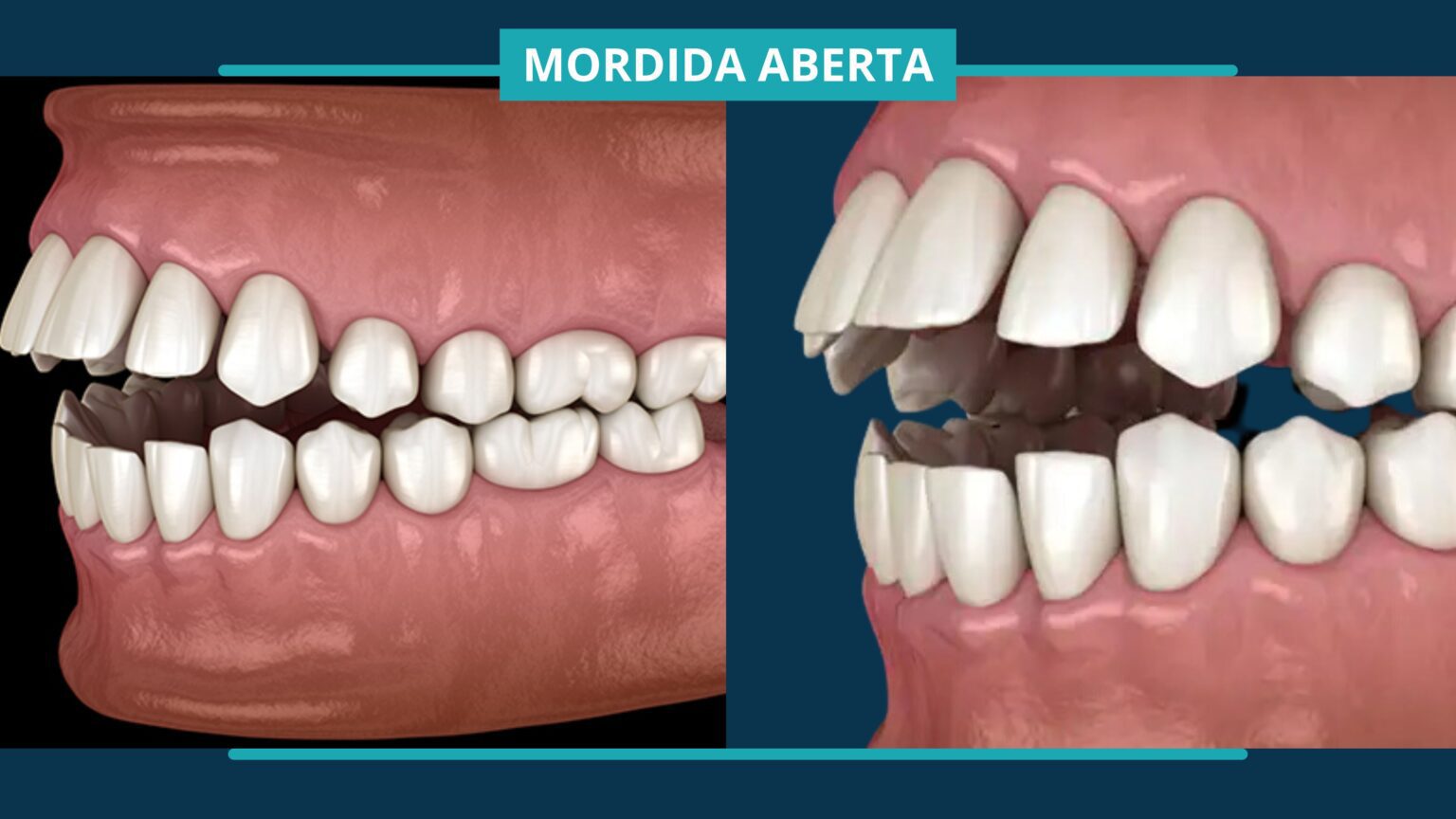 Explorando Abordagens Cirurgia Ortognática em Pacientes com Mordida ...